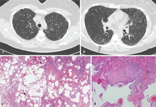 Idiopathische Lungenfibrose | SpringerLink