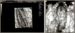 2D and 3D Ultrasound Examination of Labia Minora | SpringerLink