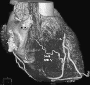 Arterial supply of the sinoatrial node: a CT coronary angiographic ...