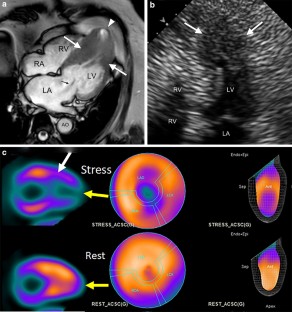 Apical variant hypertrophic cardiomyopathy “multimodality imaging ...