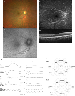 Retinal dystrophy associated with a single-base deletion mutation in ...