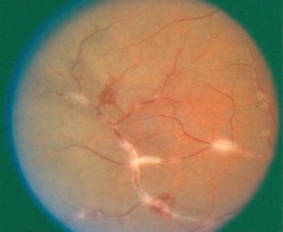 A clinical approach to the diagnosis of retinal vasculitis | SpringerLink