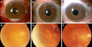 The results of pars plana vitrectomy and silicone oil tamponade for ...