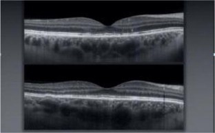Spectrum of pachychoroid diseases | SpringerLink