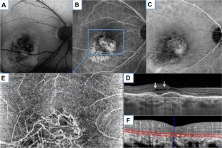 Spectrum of pachychoroid diseases | SpringerLink