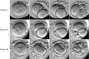 Removing the zona pellucida can decrease cytoplasmic fragmentations in ...