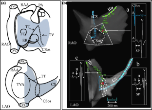 Anatomical and electrophysiological variations of Koch’s triangle and ...
