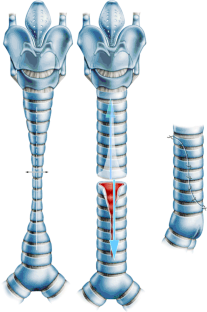 Reconstruction of defects of the trachea | SpringerLink