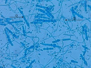 Trichophyton Rubrum with the ‘ raubitschekii ’ Morphotype: The First ...