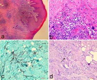 Successful Treatment of a Necrotizing Fasciitis Patient Caused by Mucor ...