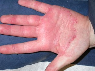 Non-dermatophyte Dermatoses Mimicking Dermatophytoses in Humans ...
