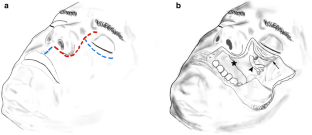 Surgical management of anterior skull-base malignancies (endoscopic vs ...