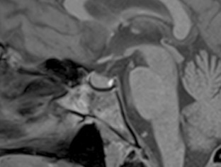 Presence of the posterior pituitary bright spot sign on MRI in the ...