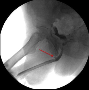 Novel pericatheter retrograde urethrogram technique is a viable method ...