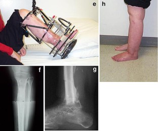 Limb Salvage Reconstruction of the Ankle with Fusion and Simultaneous ...