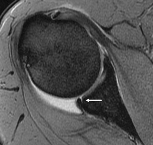 Posterior Chondrolabral Cleft: Clinical Significance and Associations ...