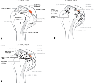 All-Arthroscopic Modified Rotator Interval Slide for Massive ...