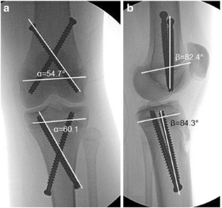 Percutaneous Epiphysiodesis Using Transphyseal Screws: a Case Series ...