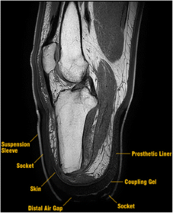 A finite element model to assess transtibial prosthetic sockets with ...