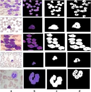 Detection of acute lymphoblastic leukemia using image segmentation and ...