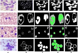 Detection of acute lymphoblastic leukemia using image segmentation and ...
