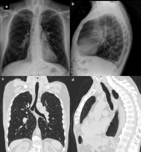 Saber-sheath trachea as a marker of severe airflow obstruction in ...