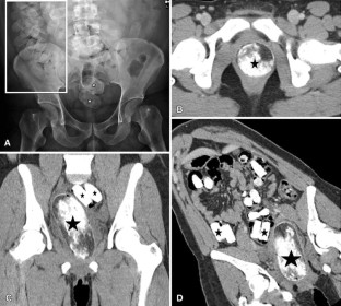 Body packing: a review of general background, clinical and imaging ...