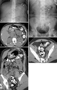 Body packing: a review of general background, clinical and imaging ...