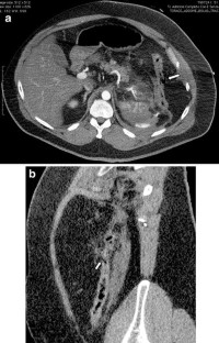 Bowel and mesenteric injuries from blunt abdominal trauma: a review ...
