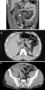Bowel and mesenteric injuries from blunt abdominal trauma: a review ...