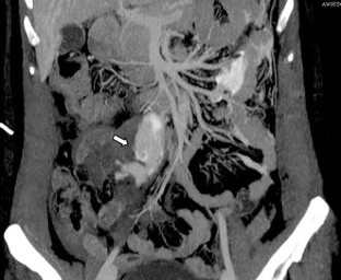 Bowel and mesenteric injuries from blunt abdominal trauma: a review ...