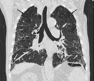 Combined pulmonary fibrosis and emphysema (CPFE): what radiologist ...