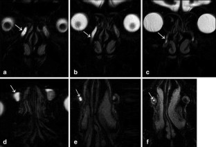 MR dacryocystography: comparison with dacryoendoscopy in positional ...