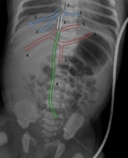 Umbilical venous catheters placement evaluation on frontal radiogram ...