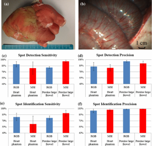 An endoscopic structured light system using multispectral detection ...