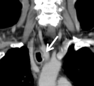 Tracheo-innominate artery fistula successfully treated by endovascular ...