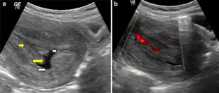 Sonographic and MR features of puerperal uterine inversion | SpringerLink