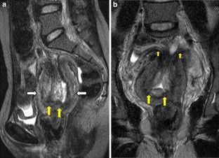 Sonographic and MR features of puerperal uterine inversion | SpringerLink