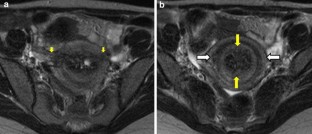 Sonographic and MR features of puerperal uterine inversion | SpringerLink