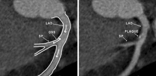 Proximal LAD atherosclerosis: milking-like effect of the septal ...