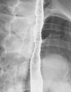 The imaging features of protruding esophageal lesions | SpringerLink