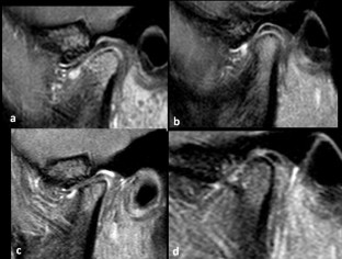 Imaging findings of mixed connective tissue disease in children and ...