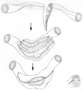 A Comprehensive Review of Strictureplasty Techniques in Crohn’s Disease ...
