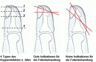 Fingerkuppendefekte | SpringerLink