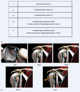 Arthroskopische Rekonstruktion der Subscapularissehne | SpringerLink