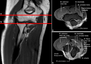 Instabilitätsrelevante Anatomie des Ellenbogens | SpringerLink