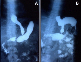 Laparoscopic Sleeve-Collis-Nissen Gastroplasty: a Safe Alternative for ...