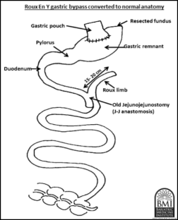 Indications and Operative Outcomes of Gastric Bypass Reversal ...