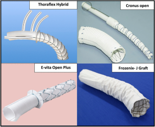 Is the frozen elephant trunk frozen? | SpringerLink