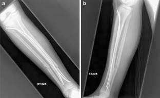 Titanium elastic nails for pediatric tibial shaft fractures | SpringerLink